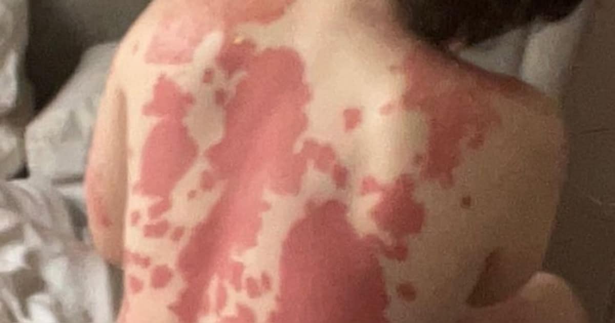 Elle se réveille avec des taches rouges sur le corps et découvre qu ...