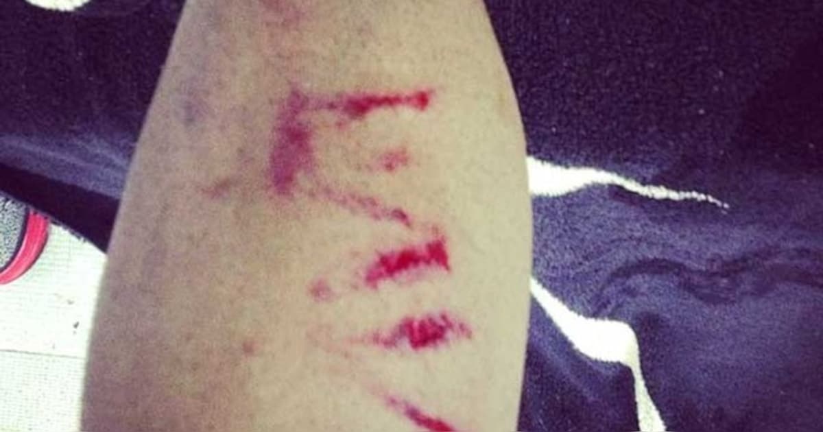 Le tibia de Daniel Alves dans un sale état | 7sur7.be