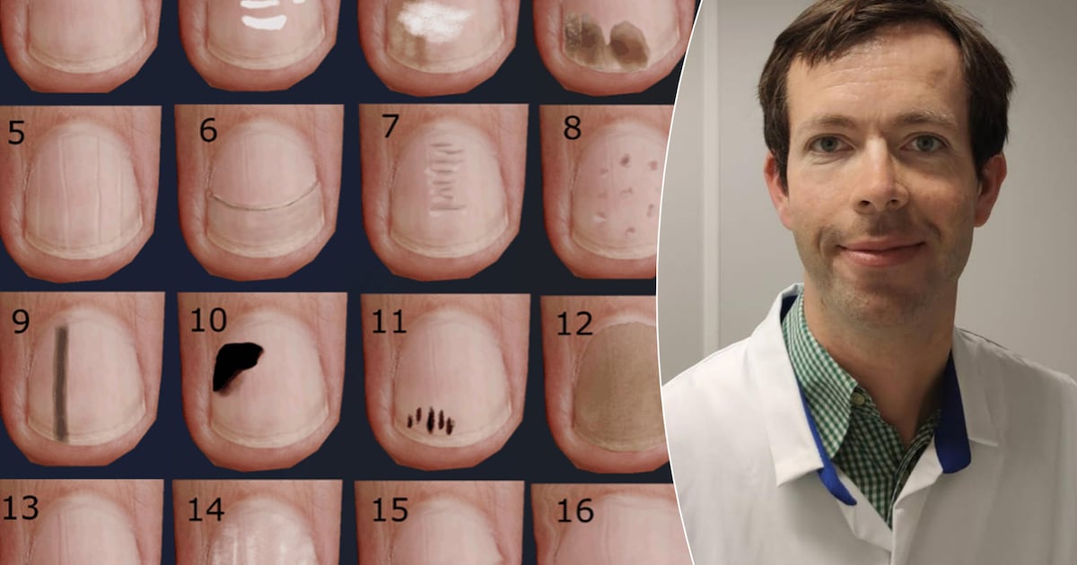 Ce que les taches et fissures sur vos ongles révèlent de votre santé ...