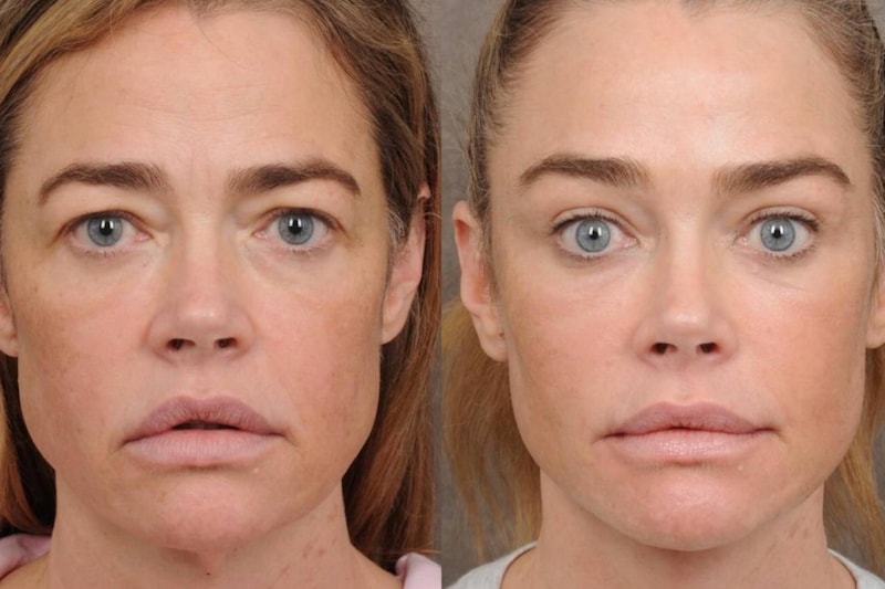 “Je ne me reconnaissais plus”: Denise Richards dévoile son visage après ...