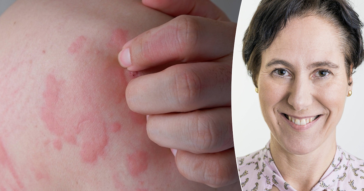“La cortisone n’est pas la solution”: des plaques rouges qui ...