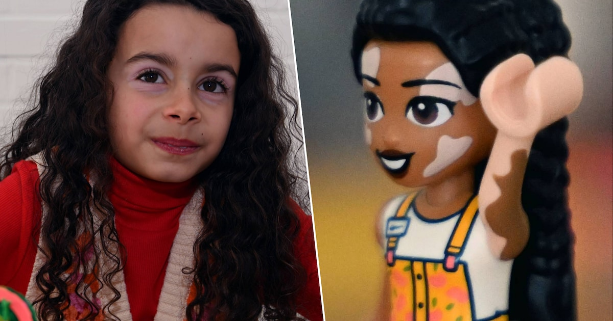 "Maman, regarde... C'est moi!": atteinte de vitiligo, Emily est devenue ...