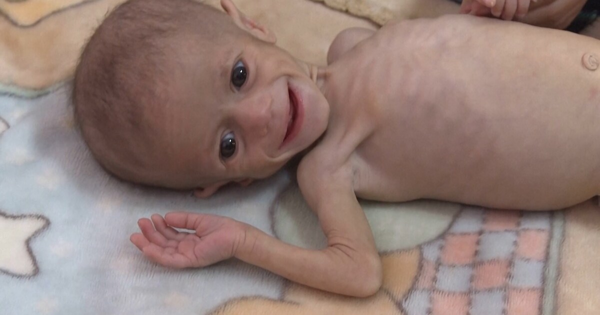 La petite Siwar, âgée de six mois et symbole de la famine à Gaza, a ...