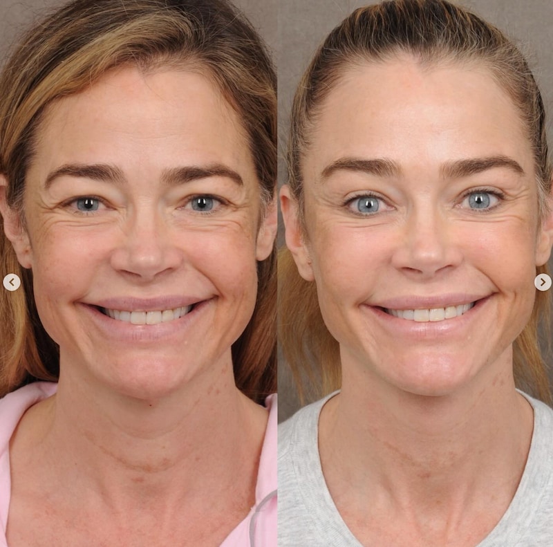 “Je ne me reconnaissais plus”: Denise Richards dévoile son visage après ...