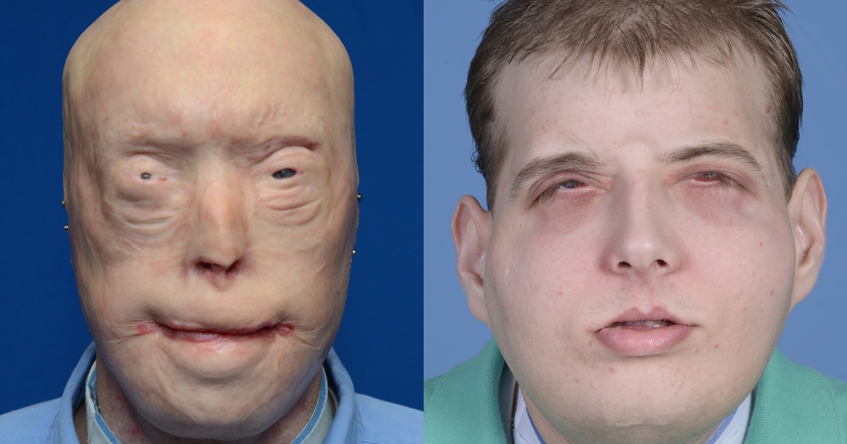 Une greffe du visage exceptionnelle | 7sur7.be