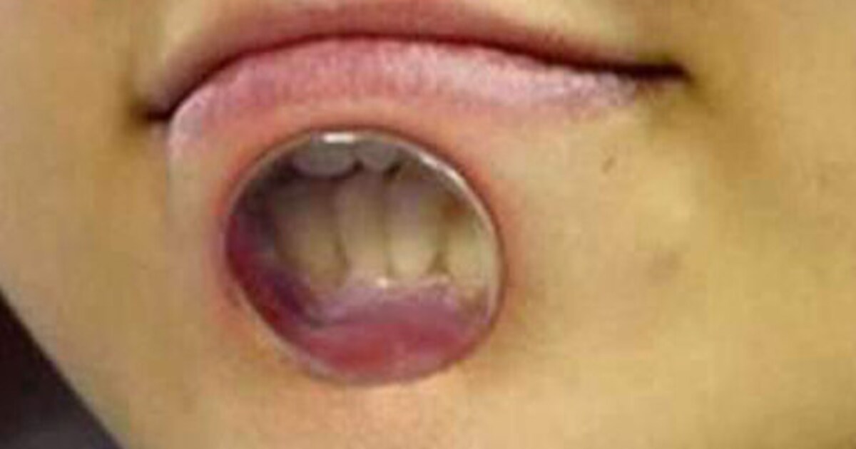 Le piercing à la mode? Une lentille dans le menton! | 7sur7.be